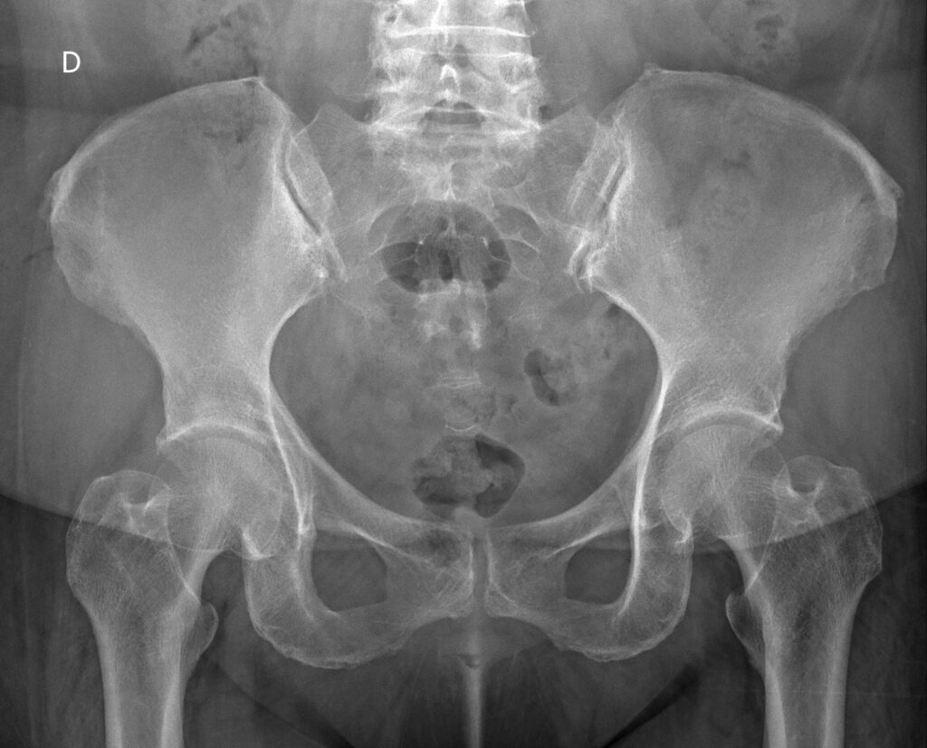 Radiografía de Pelvis AP – CIMRO BACK